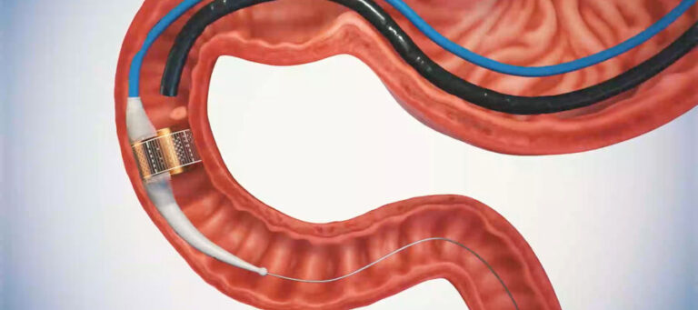 Endogenex – Help Control Type 2 Diabetes – Bringing New Energy to the ...